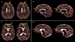 BrainSuite Diffusion Pipeline · BrainSuite
